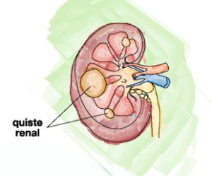 Consecuencias de tener un quiste en el riñón: ¿Qué debes saber?